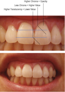 Shade Taking Made REALLY EASY! | Dental Laboratory AssociatesDental ...